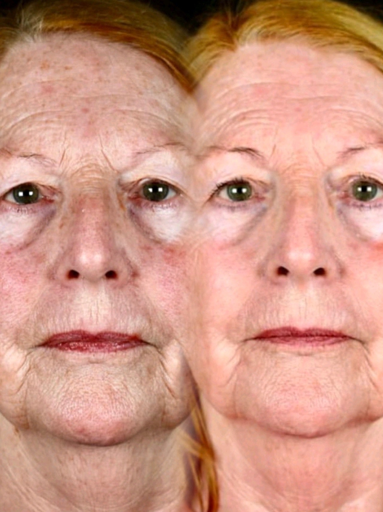 Sydney CO2 Laser Facial Treatment | Salon Station – SALON STATION